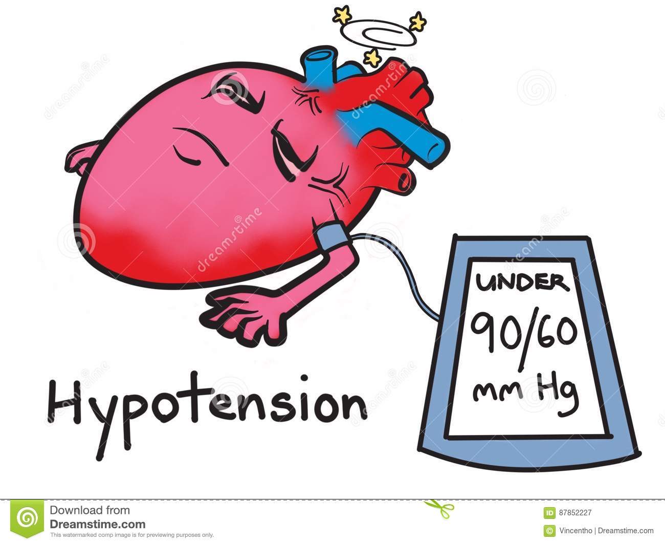 Fisioterapia De La Serna La Hipotensión Fisioterapia De La Serna